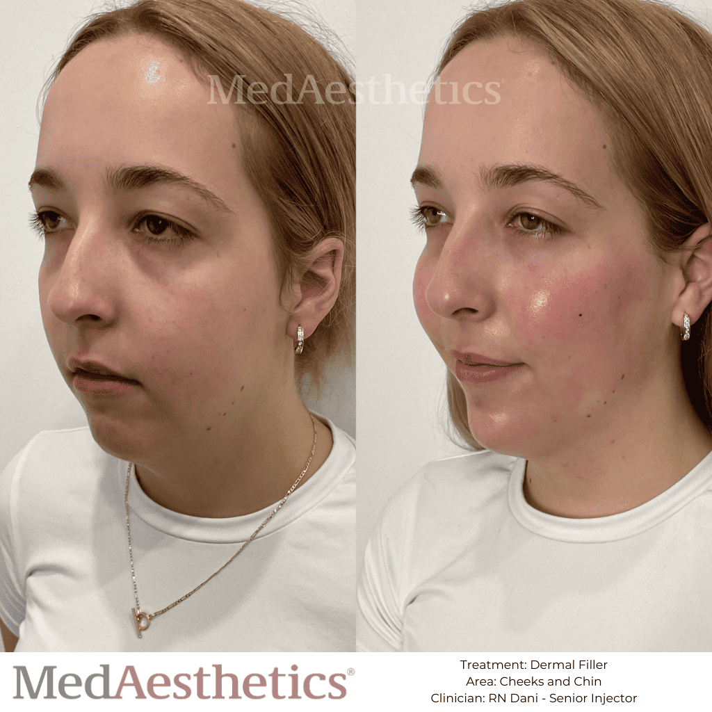 Dermal Fillers Perth | Cheek Fillers - Medaesthetics